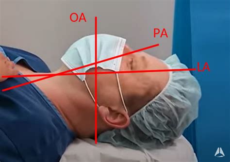 Image result for Intubation Position