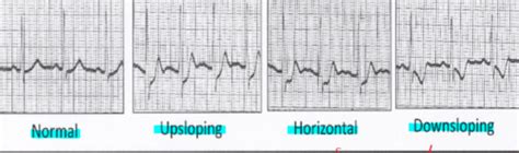 Image result for Types of ST Depression