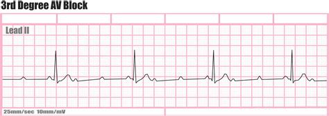 Image result for Heart Block Angiogram