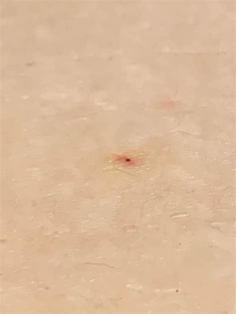 Image result for Dexcom Sensor Filament Structure