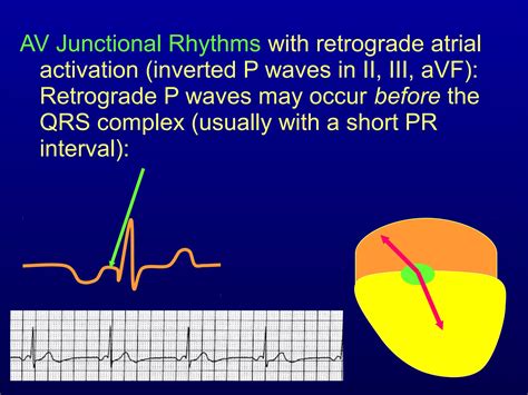 Image result for PR Interval ECG