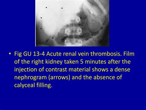 Image result for Nephrogram Phase Timing