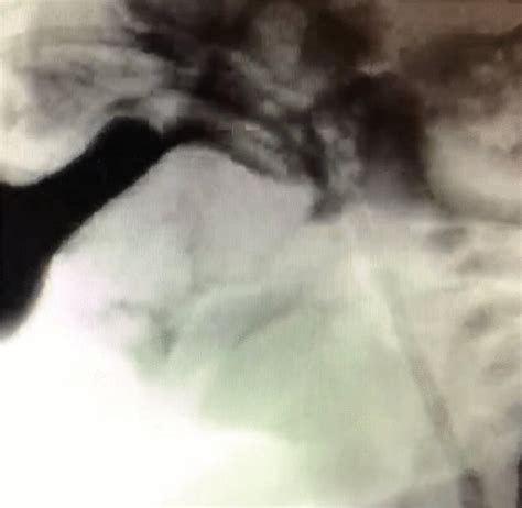 Image result for VFSS Procedure