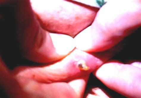 Image result for Human Botfly