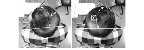 Image result for Neck Rotation Clockwise ROM