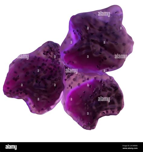 Image result for Diffuse Large Cell Lymphoma