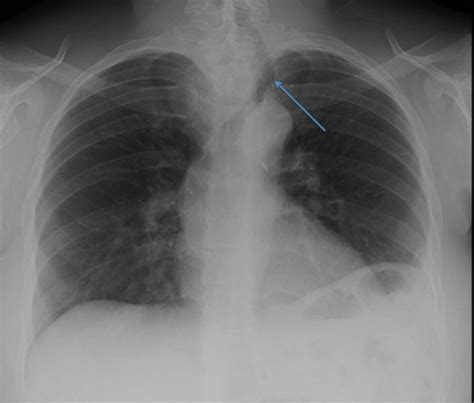 Image result for Intrapulmonary Air Space