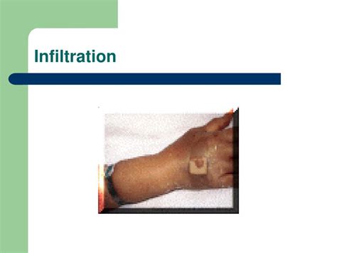 Image result for IV Line Infiltration