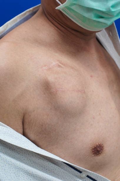 Image result for Recovery After Pacemaker Surgery