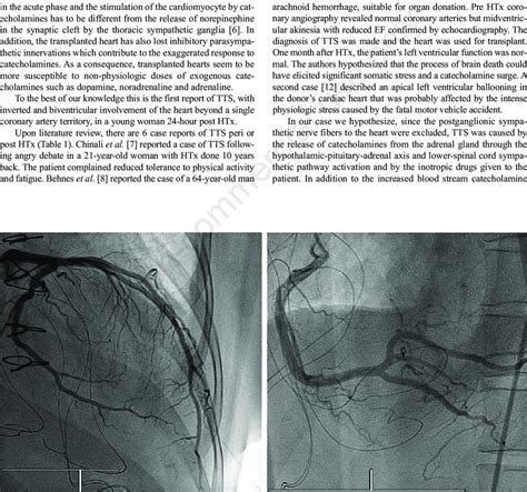 Image result for Normal Coronary Angiogram