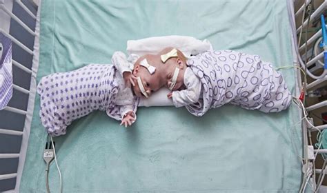 Image result for Java Island Siamese Twins