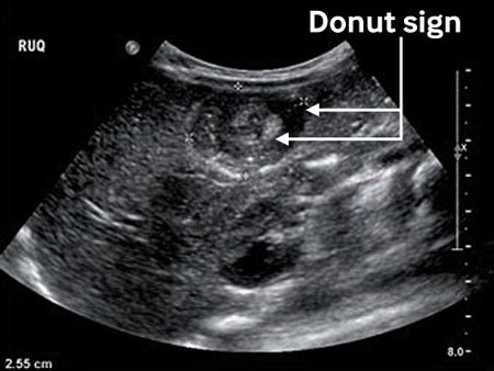Image result for Intussusception Pseudokidney Sign