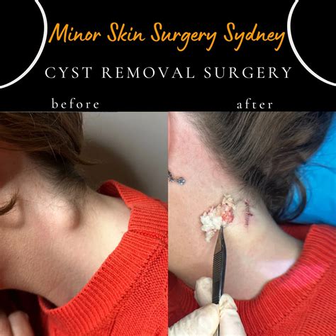 Image result for Upper-Back Cyst Surgery