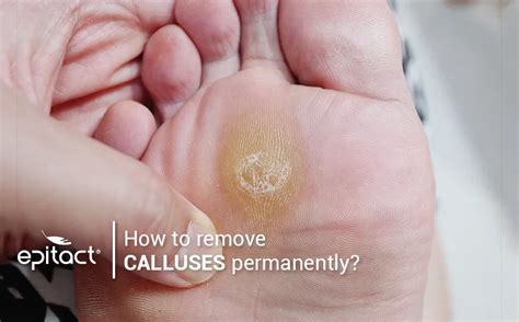 Image result for How to Remove Calluses Forever