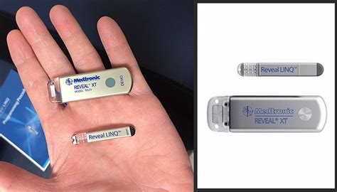 Image result for Loop Recorder Surgery