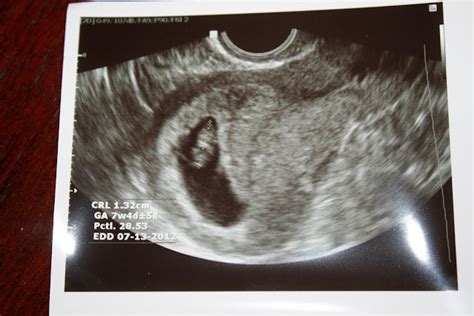 Finally Expecting!: 7 week 4 day ultrasound!
