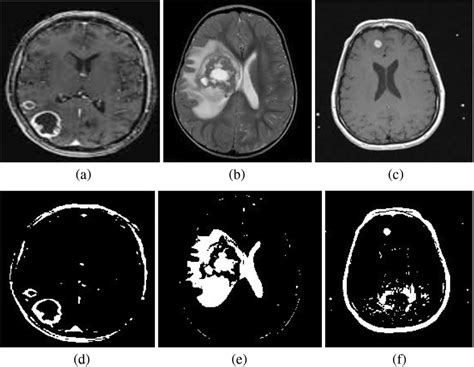 Image result for Brain Tumor Detection Classification Using SVM