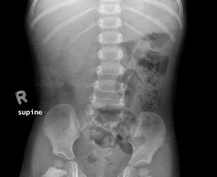 Image result for Intussusception
