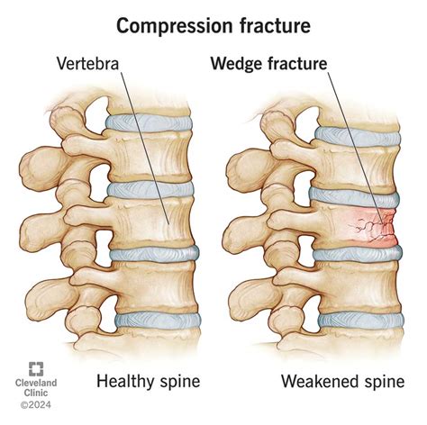 Image result for Surgery for Compression Fracture