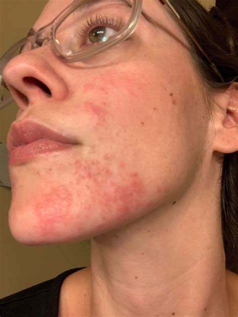 Image result for Seb Derm