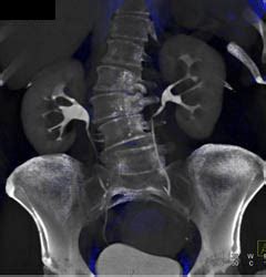 Image result for Urogram CT Scan with Contrast Normal