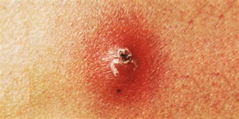 Image result for Carbuncle Extraction Surgery