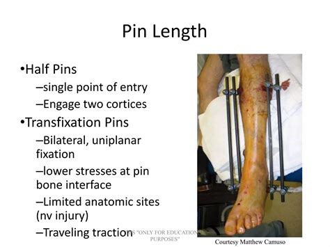 Image result for External Fixator Surgery