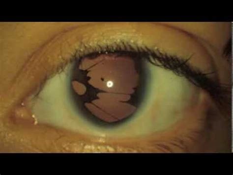 Image result for Red Reflex