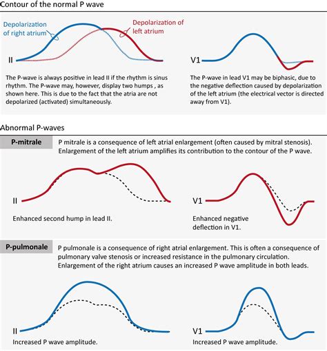 Image result for PR Interval Abnormalities