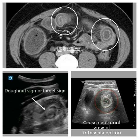 Image result for Intussusception Pseudokidney Sign