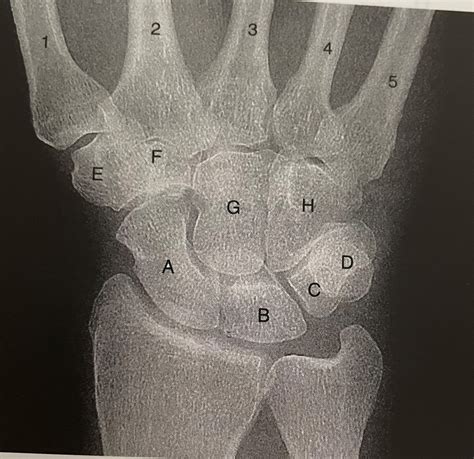 Image result for Wrist Arthrogram