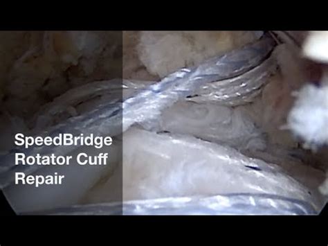 Image result for SpeedBridge Rotator Cuff