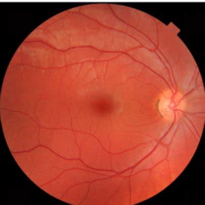 Image result for Red Reflex