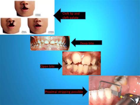 Image result for Problems with Serial Extraction