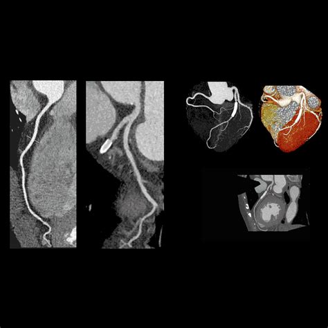 Image result for Normal Coronary CT Angiogram