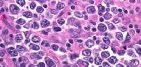 Image result for Diffuse Large Cell Lymphoma