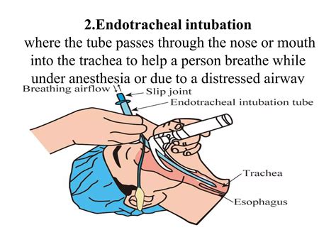 Image result for Intubation Procedure