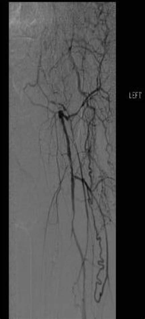 Image result for Left Lower Extremity Angiogram