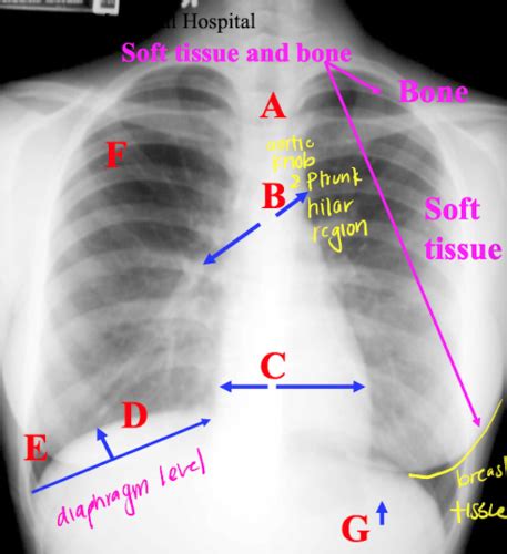 Image result for Intrapulmonary Air Space