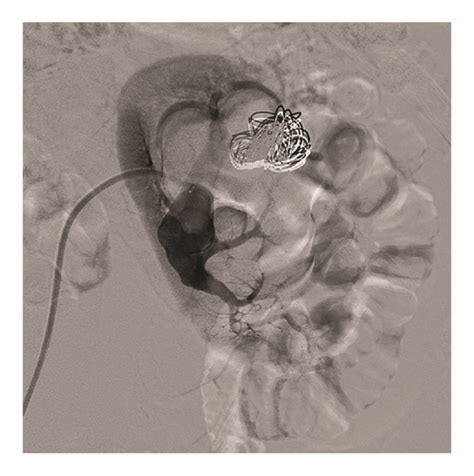 Image result for Angiogram with Embolization