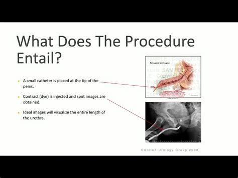 Image result for Urethrogram Procedure