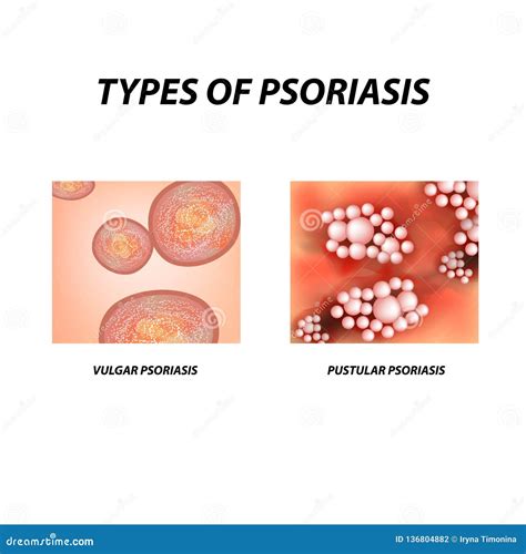 Image result for Types of Pustular Psoriasis