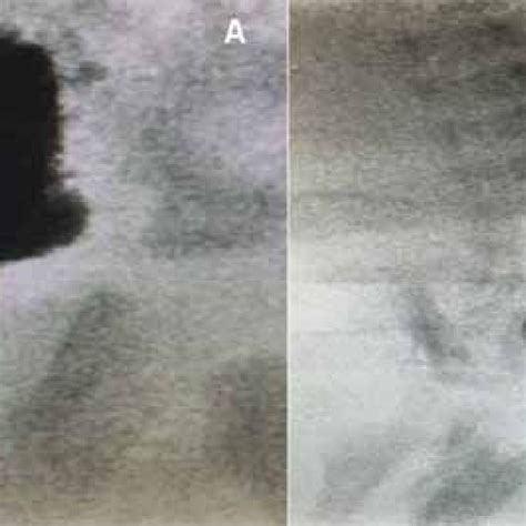 Image result for Voiding Cystourethrogram Image