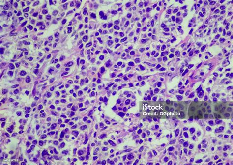 Image result for Diffuse Large Cell Lymphoma
