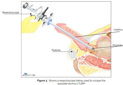 Image result for Prostate Operation Procedure