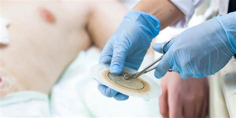 Image result for Colon Open Cancer Removal