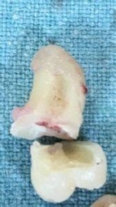 Image result for Surgical Tooth Extraction