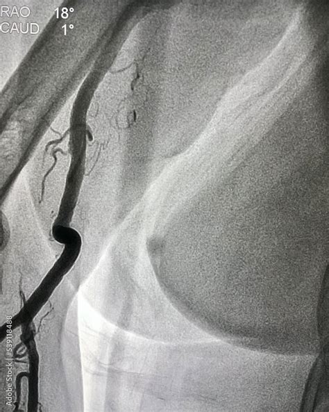 Image result for Angiogram Radial