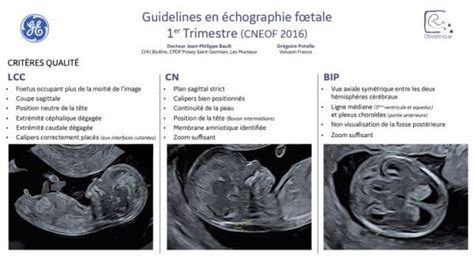 Image result for Partogramme Friedmann