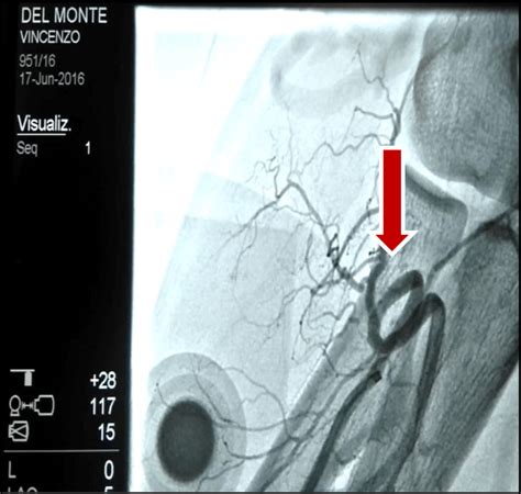Image result for Radial Loop Angiogram